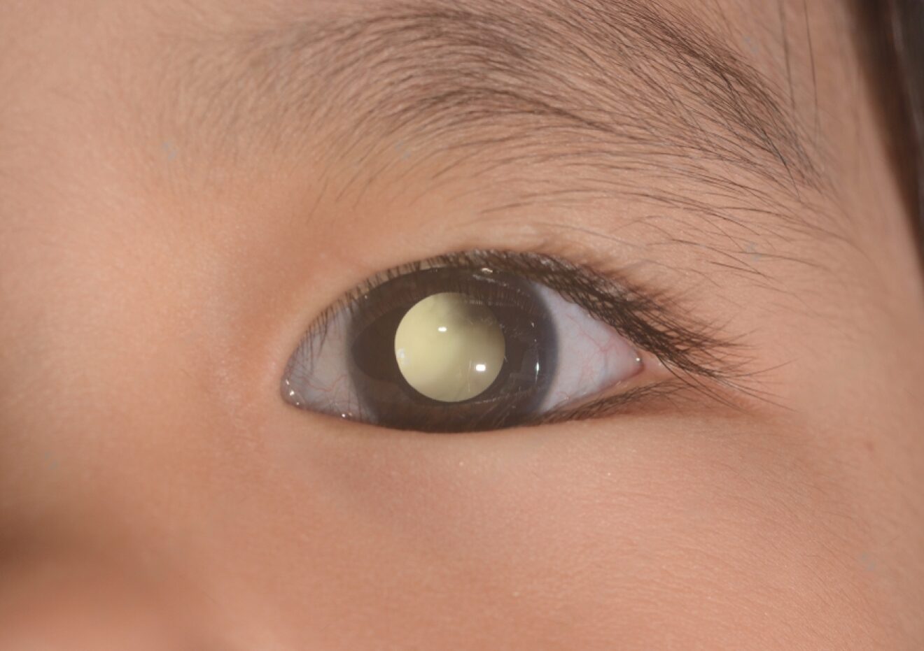 White Layer On Eye: What Is It? | Eye Info Pro