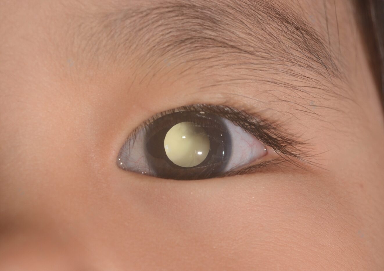 White Layer On Eye: What Is It? | Eye Info Pro